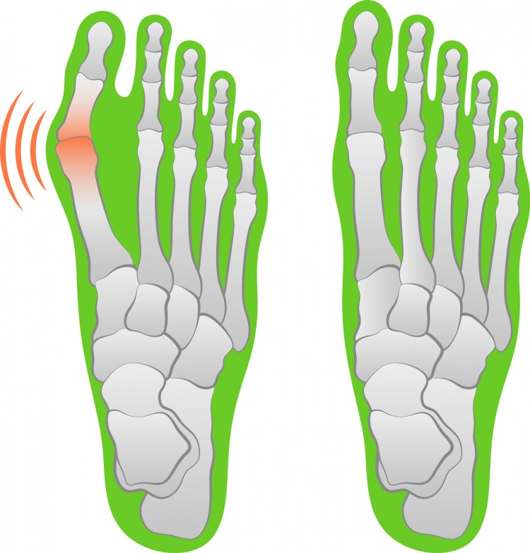 Hallux valgus | Fußschmerz-Lexikon