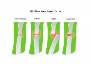 Knochenverletzung | Fußschmerz-Lexikon