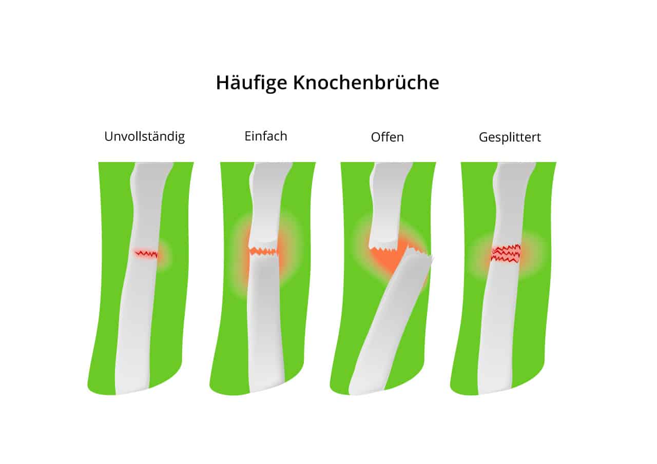 Knochenverletzung | Fußschmerz-Lexikon