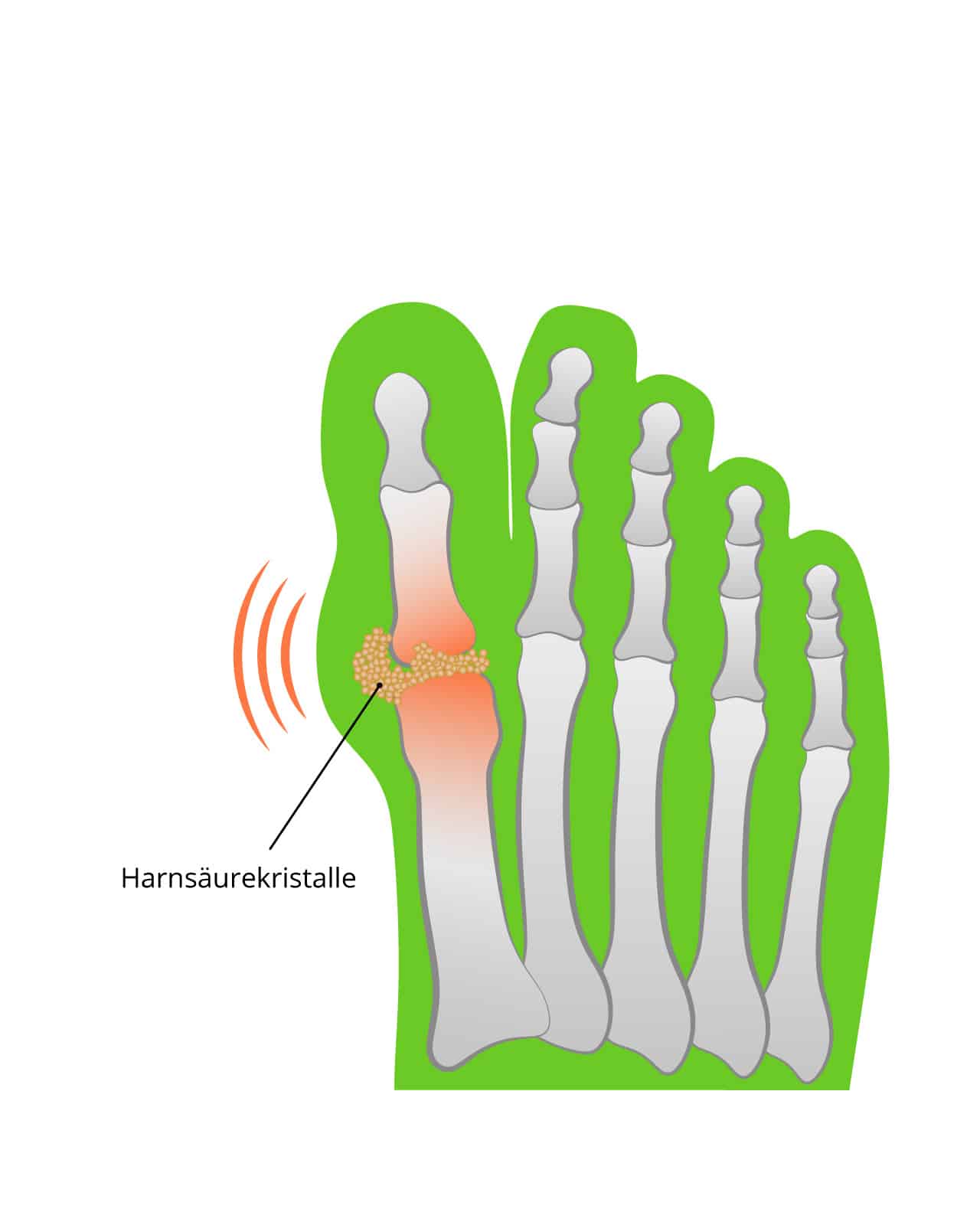 Gichtanfall im Fuß | Fußschmerz-Ratgeber